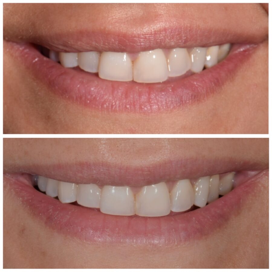 Invisalign Gallery - Dental House and Aesthetics