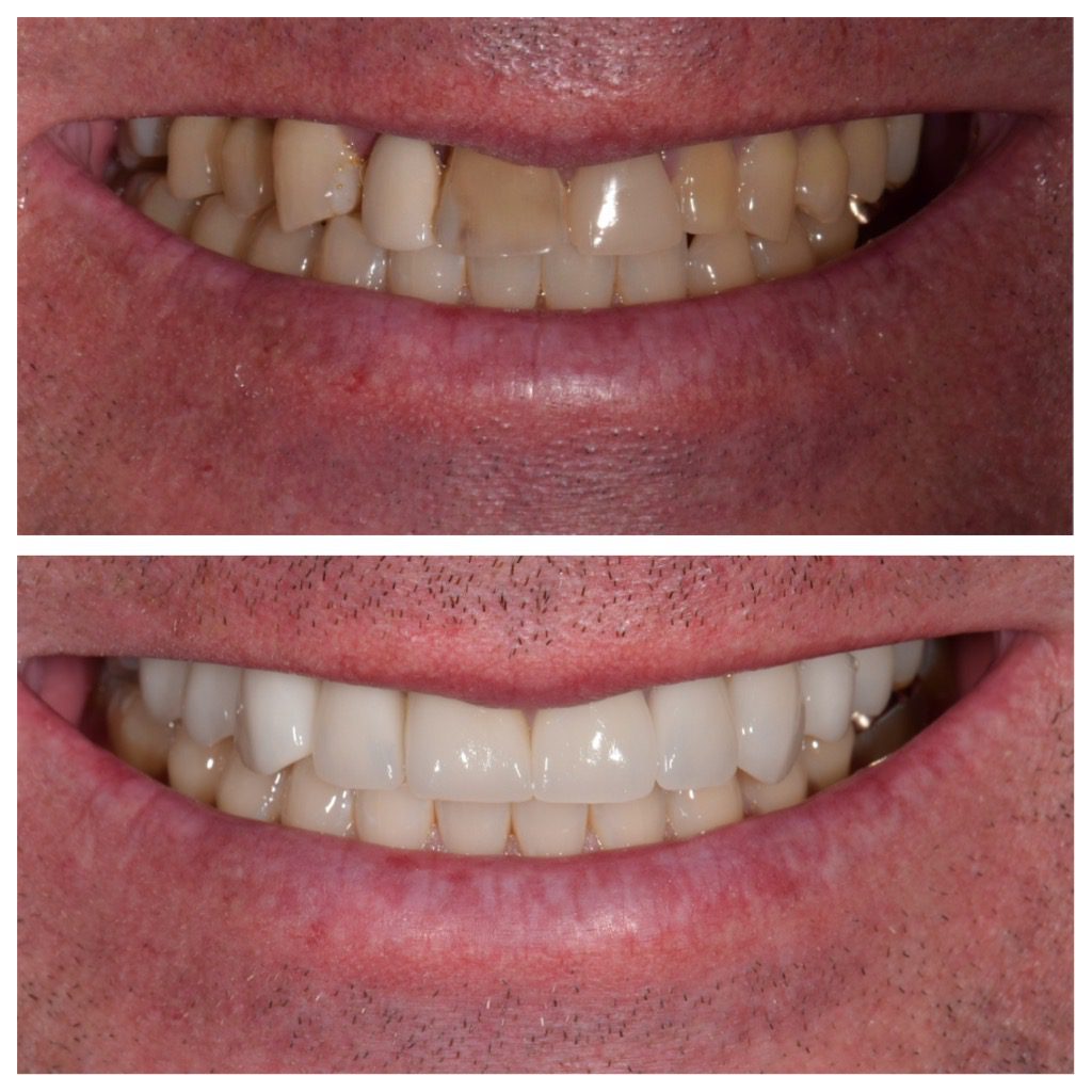Veneers Gallery - Dental House and Aesthetics